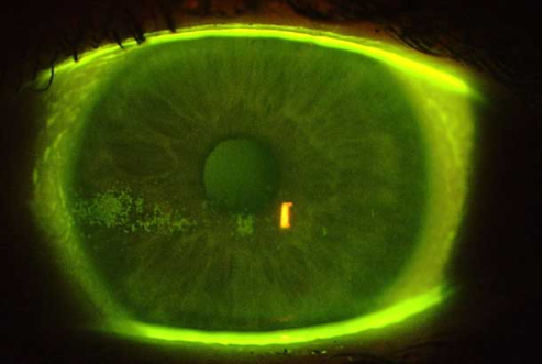 NCLE - Fluorescein Staining - Diagnostic Patterns - Optical Nerd